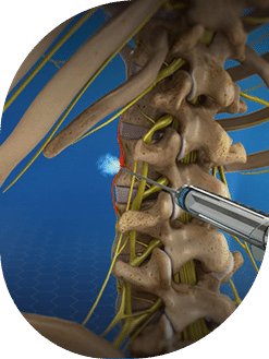 Lumbar Sympathetic Block | Nevada Pain Care